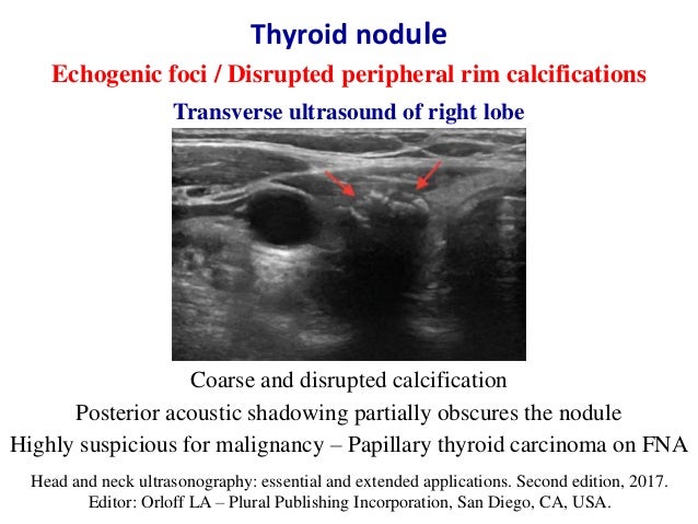 Ultrasound of thyroid nodules