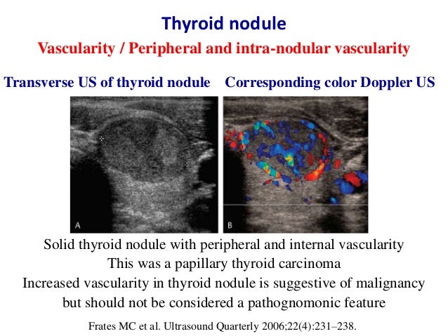Ultrasound of thyroid nodules