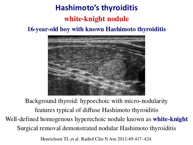 Ultrasound of thyroid nodules