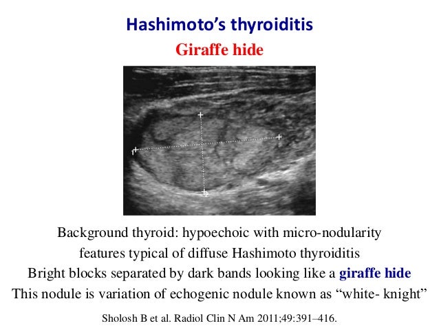 Ultrasound of thyroid nodules