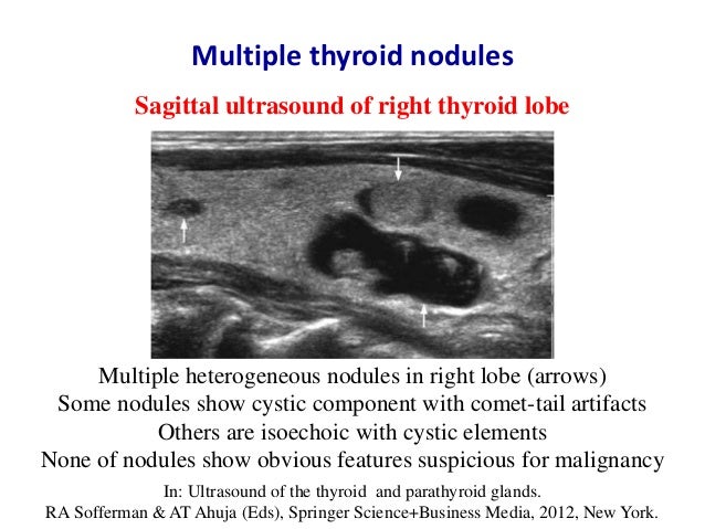 Ultrasound of thyroid nodules