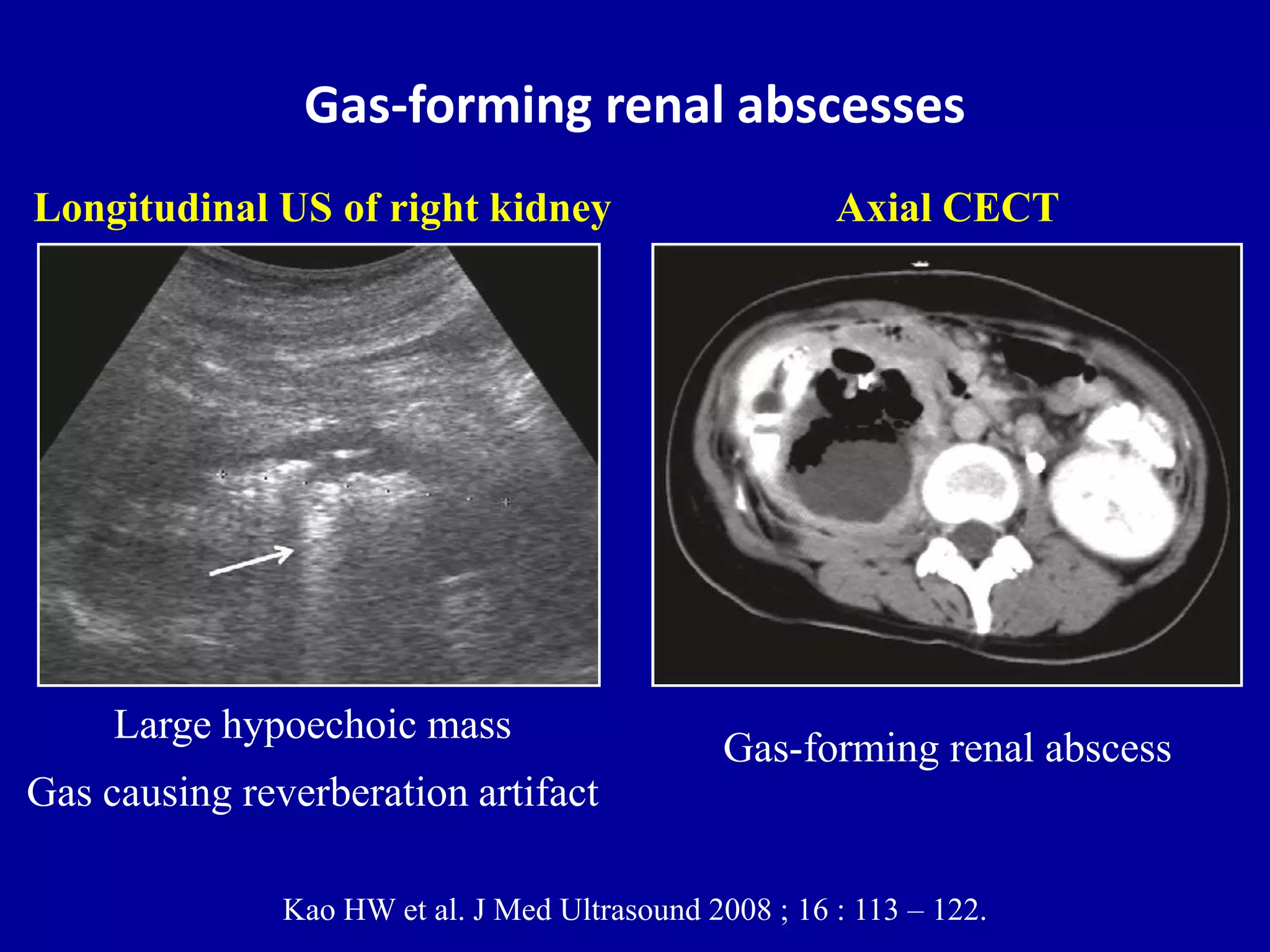 Ultrasound of the urinary tract - Renal infections | PPTX