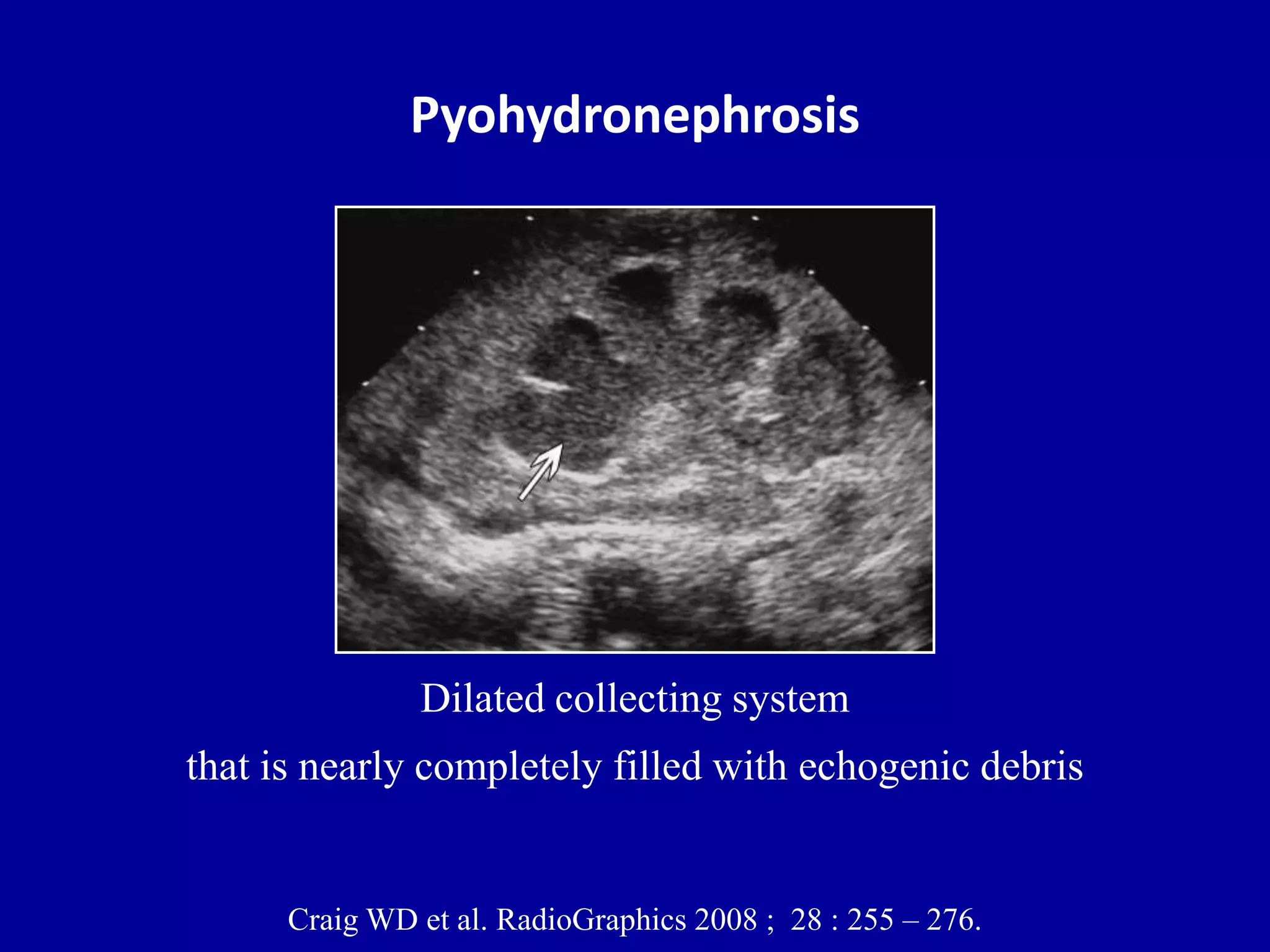 Ultrasound of the urinary tract - Renal infections | PPTX