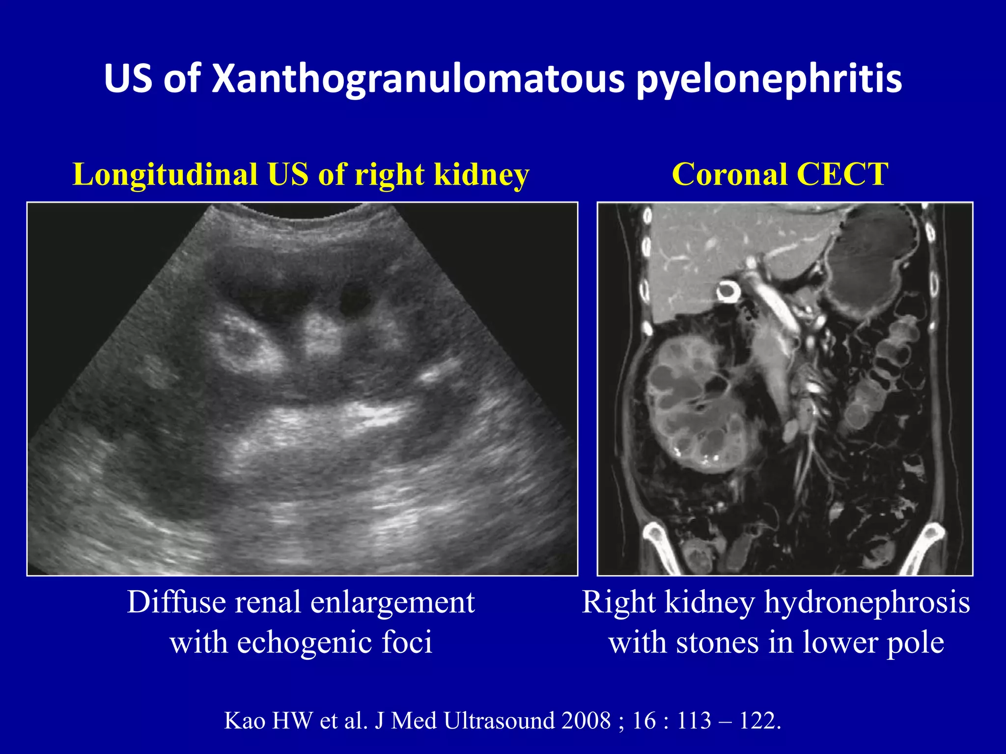 Ultrasound of the urinary tract - Renal infections | PPTX