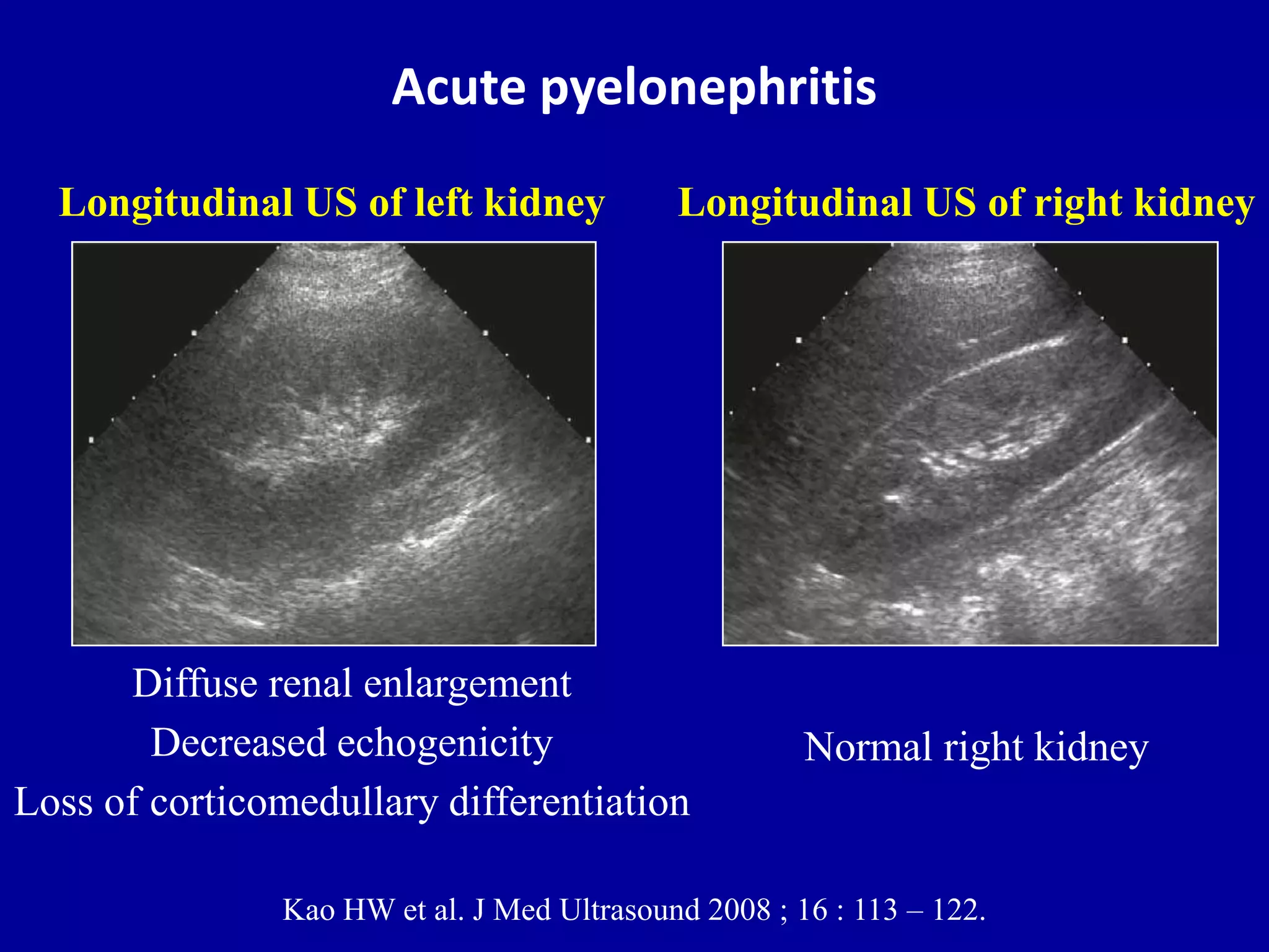 Ultrasound of the urinary tract - Renal infections | PPTX