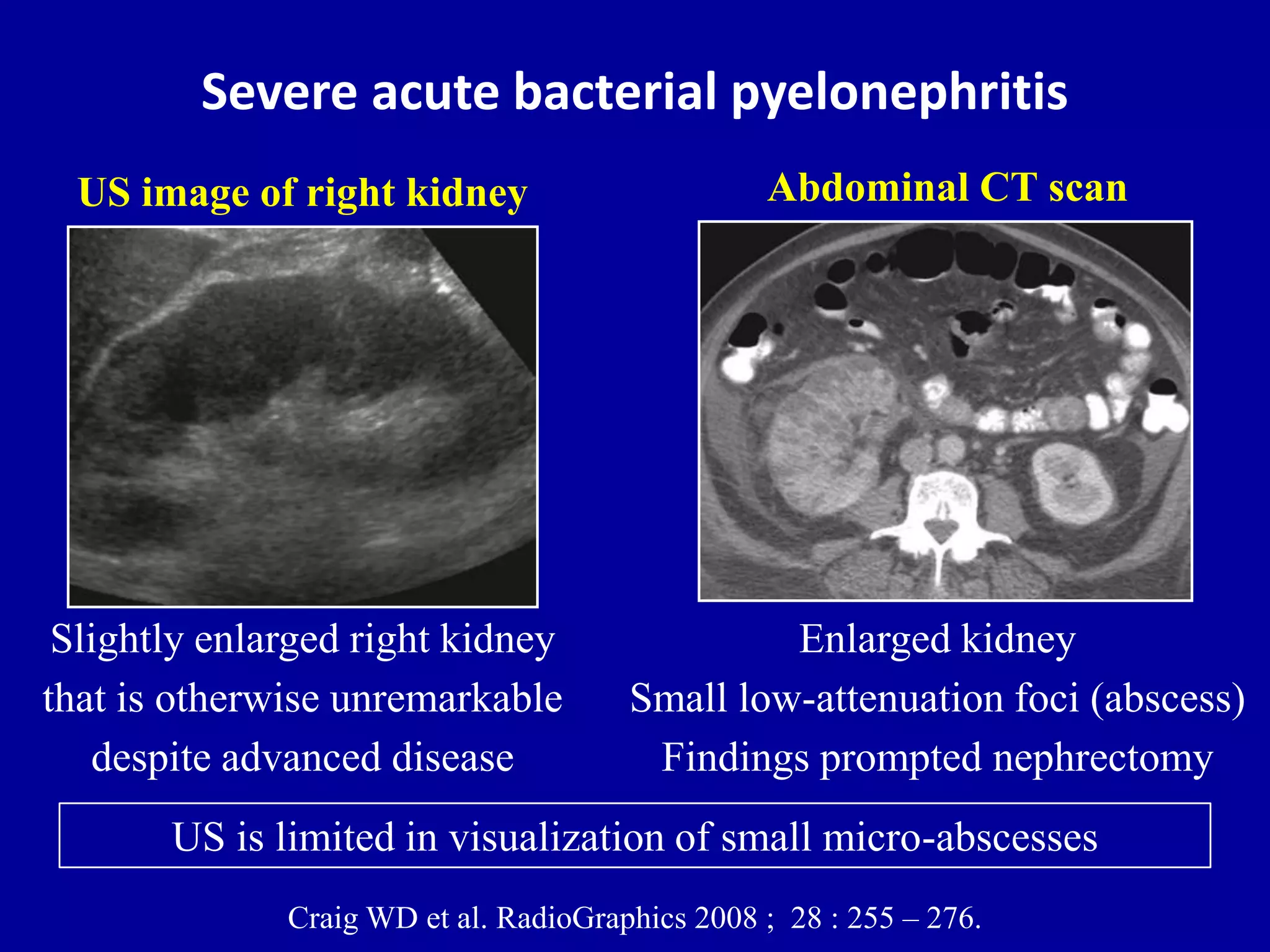 Ultrasound of the urinary tract - Renal infections | PPTX
