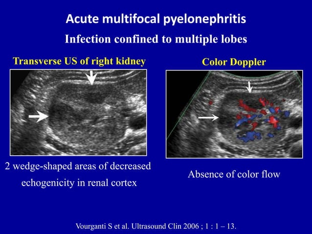 Ultrasound of the urinary tract - Renal infections | PPTX | Ear, Nose ...