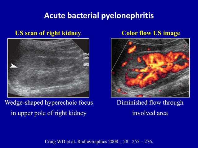 Ultrasound of the urinary tract - Renal infections | PPTX | Ear, Nose ...