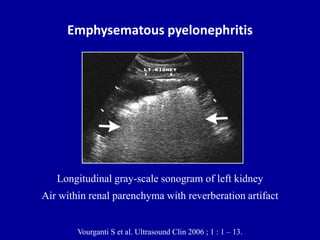 Emphysematous Pyelonephritis Ultrasound