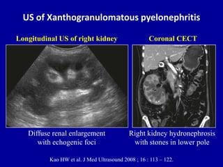 Xanthogranulomatous Pyelonephritis Ultrasound