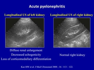 Ultrasound of the urinary tract - Renal infections | PPT