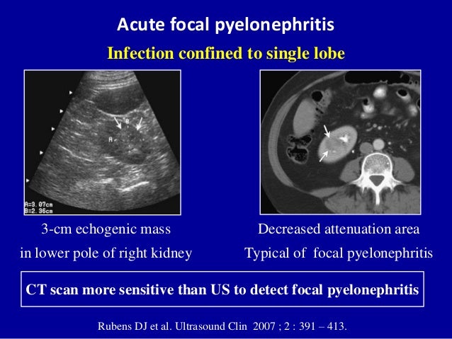 Ultrasound of the urinary tract - Renal infections
