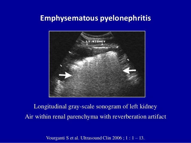 Ultrasound of the urinary tract - Renal infections