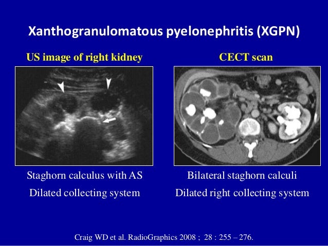 Ultrasound of the urinary tract - Renal infections