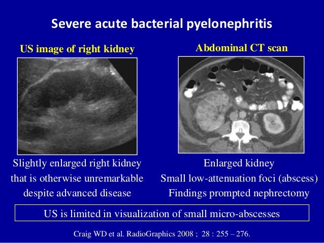 Ultrasound of the urinary tract - Renal infections