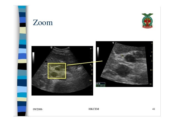 Ultrasound Physics & Knobology