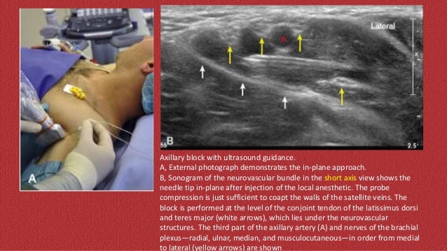 Ultrasound regional anesthesia