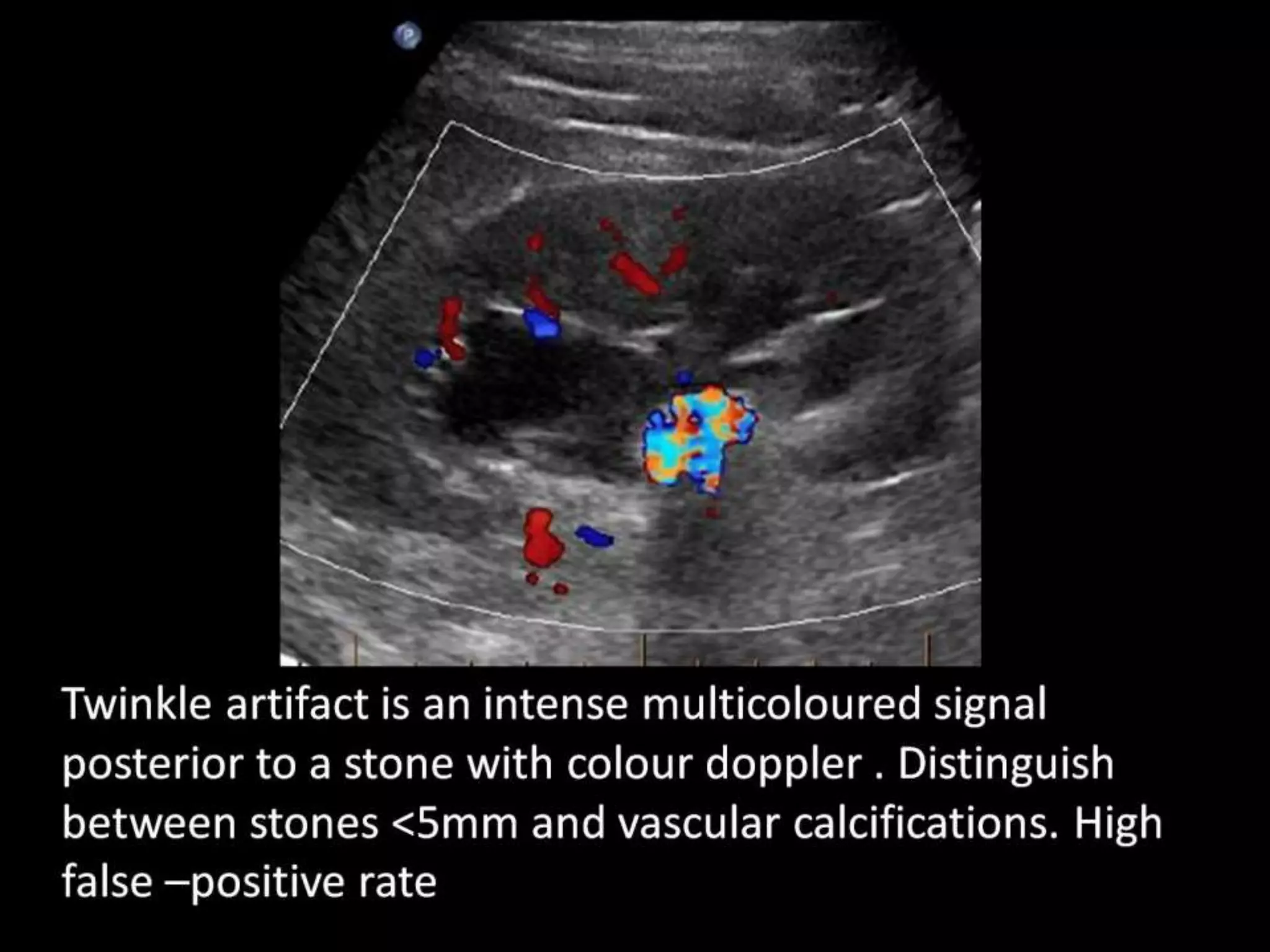 Ultrasound renal stone differential diagnosis . | PPTX