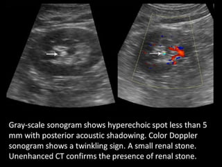 Kidney Stones Ultrasound