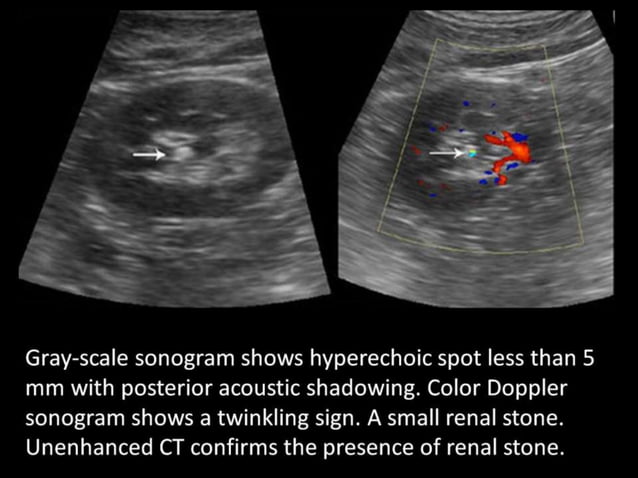 Ultrasound renal stone differential diagnosis