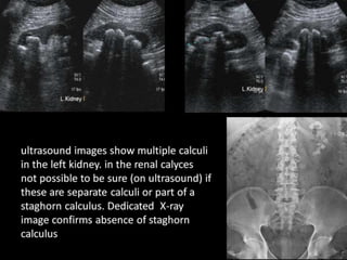 Nephrolithiasis X Ray