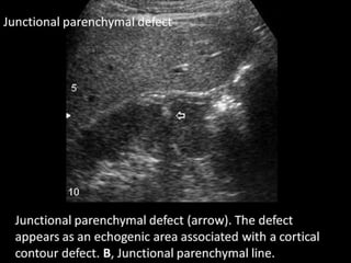 Junctional Parenchymal Defect