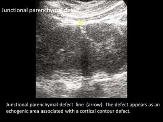 Junctional Parenchymal Defect