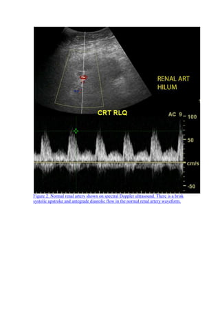 Ultrasound renal transplant | PDF