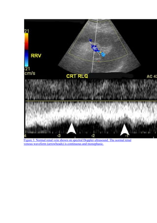 Ultrasound renal transplant | PDF