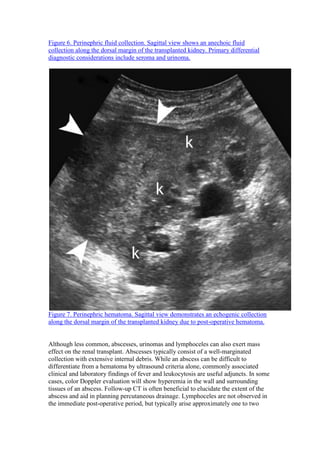 Ultrasound renal transplant | PDF
