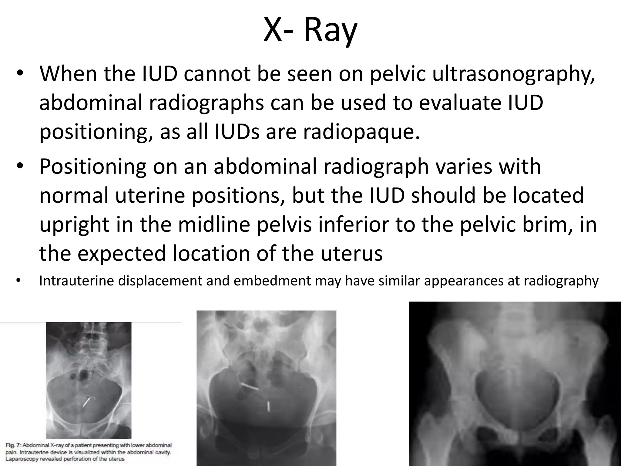 Role Of Ultrasound in assessment of iucd | PPTX | Birth Control ...