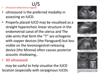 Role Of Ultrasound in assessment of iucd | PPTX | Birth Control ...