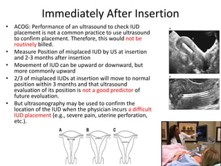 Role Of Ultrasound in assessment of iucd | PPTX