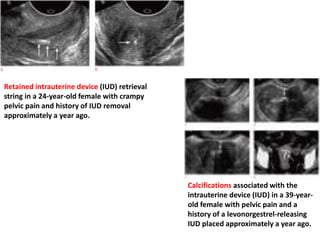 Role Of Ultrasound in assessment of iucd | PPTX