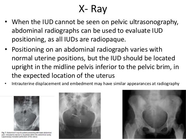 Proper Location For Iud On X Ray STOCK IMAGE, X Ray Of The Pelvis