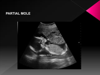 Ultrasound in obstetrics | PPTX