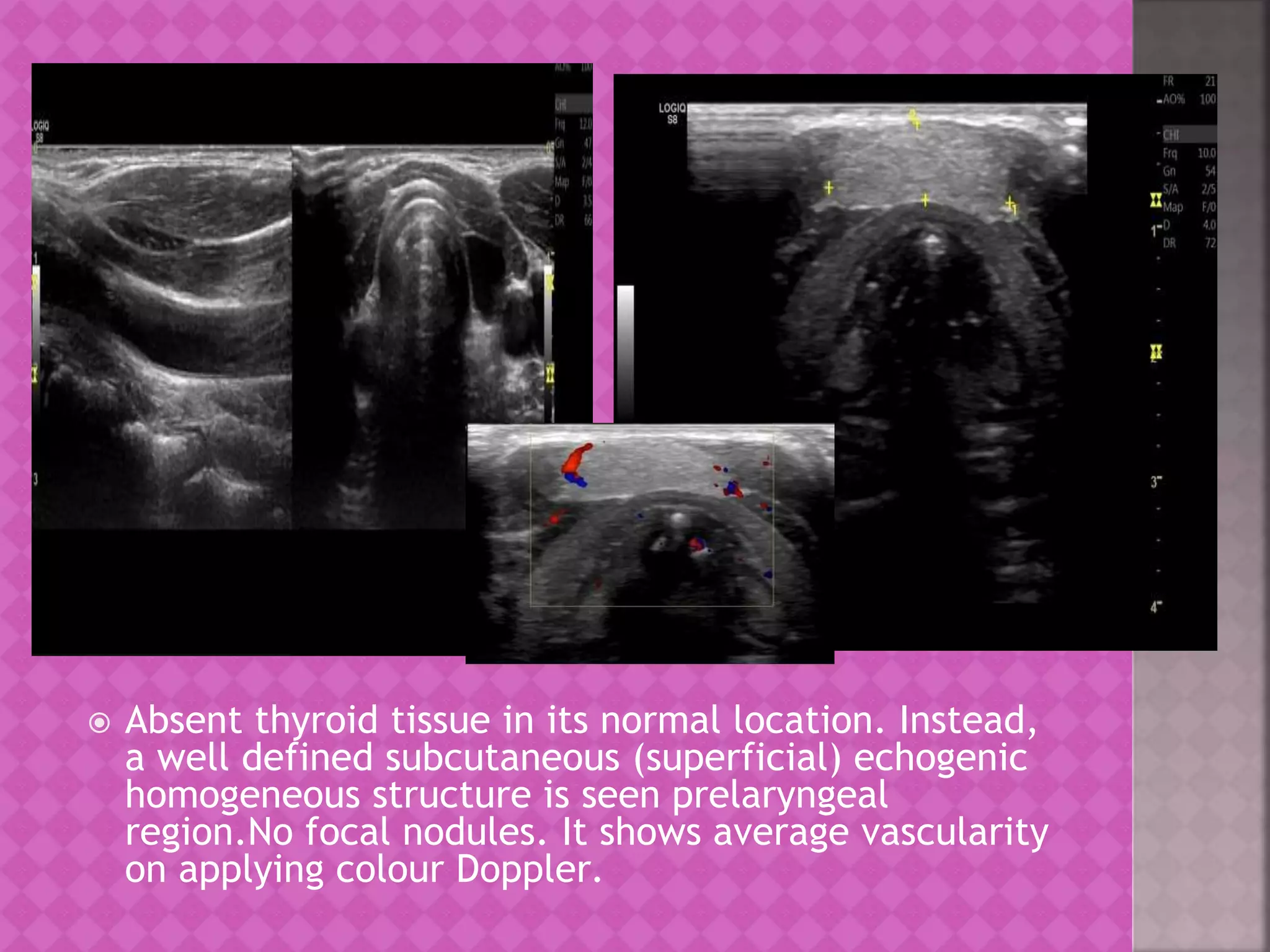 ULTRASOUND THYROID .pptx