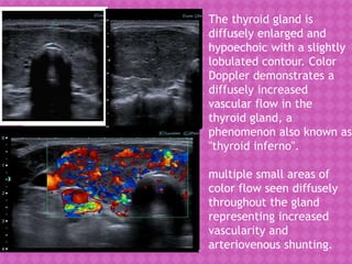 ULTRASOUND THYROID .pptx