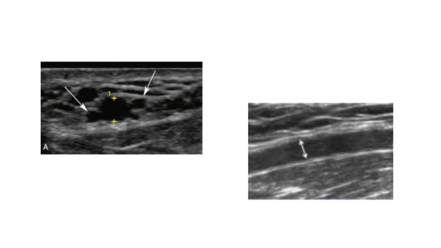 Ultrasound vascular mapping. | PDF
