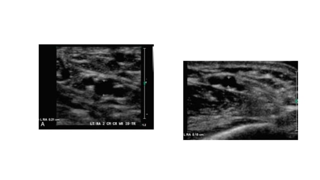 Ultrasound vascular mapping. | PDF