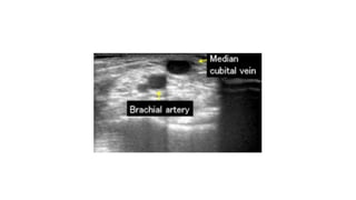Ultrasound vascular mapping. | PDF