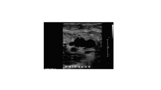 Ultrasound vascular mapping. | PDF