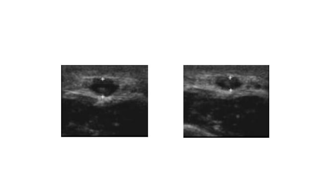 Ultrasound vascular mapping. | PDF