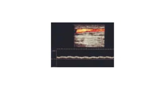 Ultrasound vascular mapping. | PDF