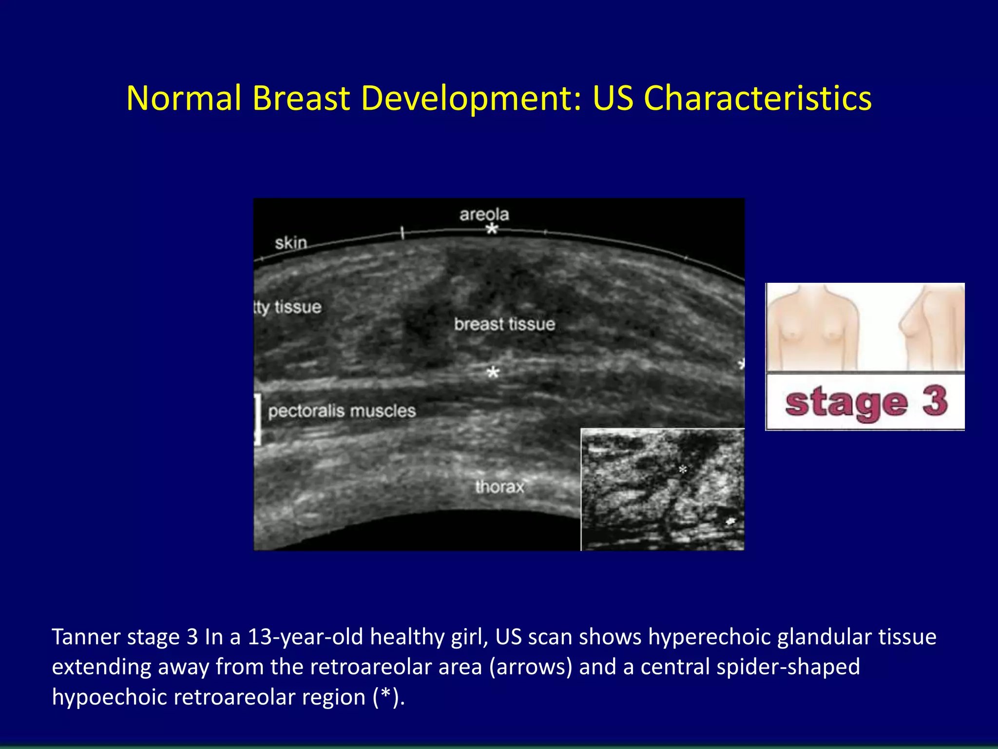 Ultrasound of pediatric and adolescent breast | PPTX