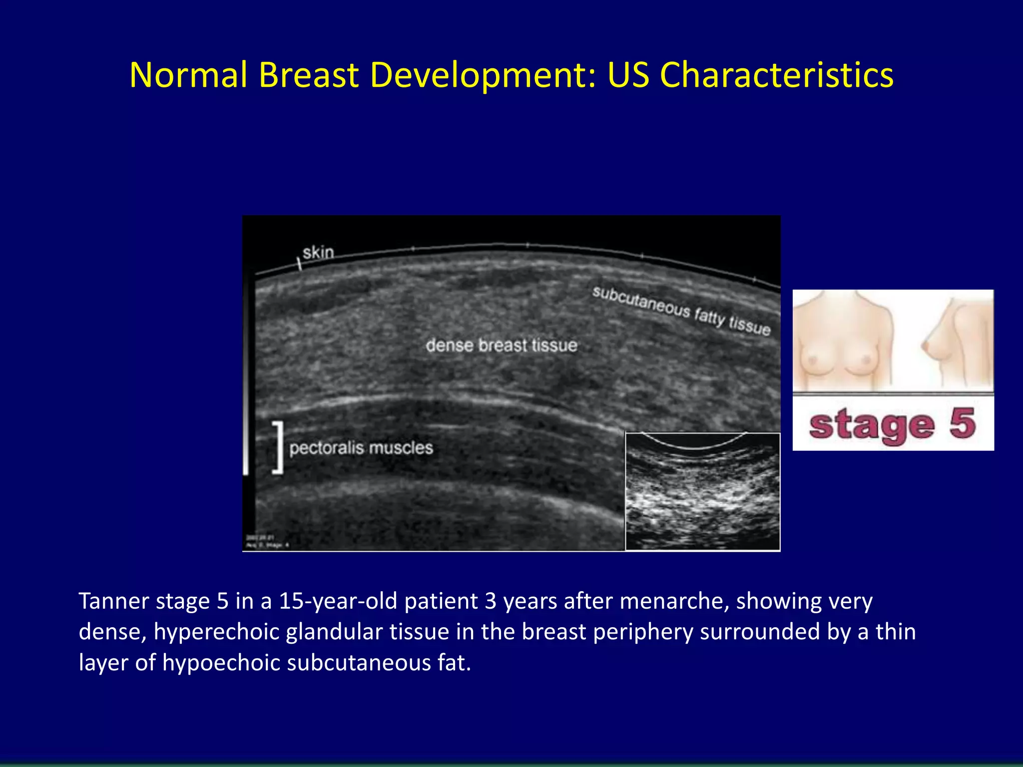 Ultrasound of pediatric and adolescent breast | PPTX