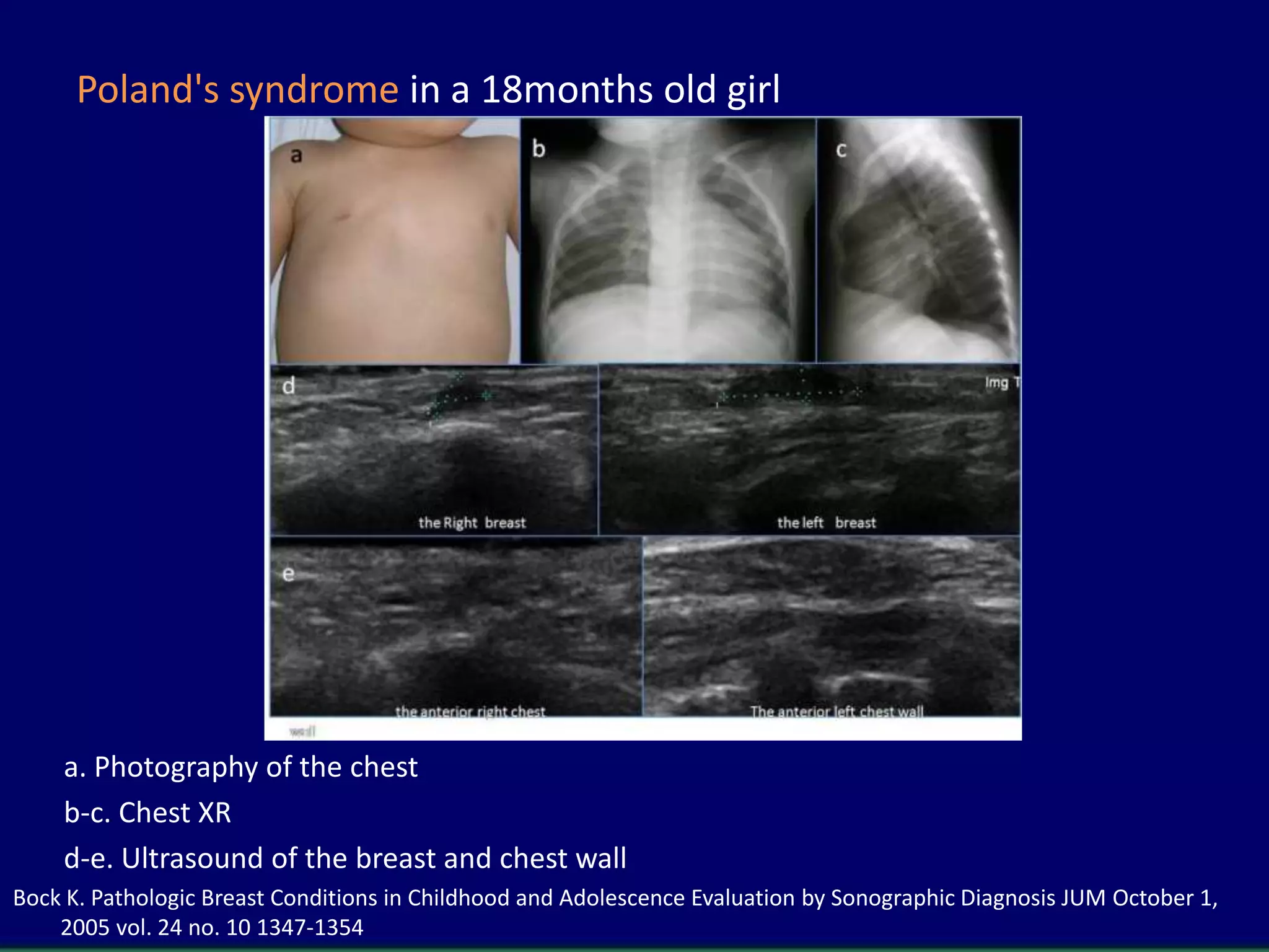 Ultrasound of pediatric and adolescent breast | PPTX