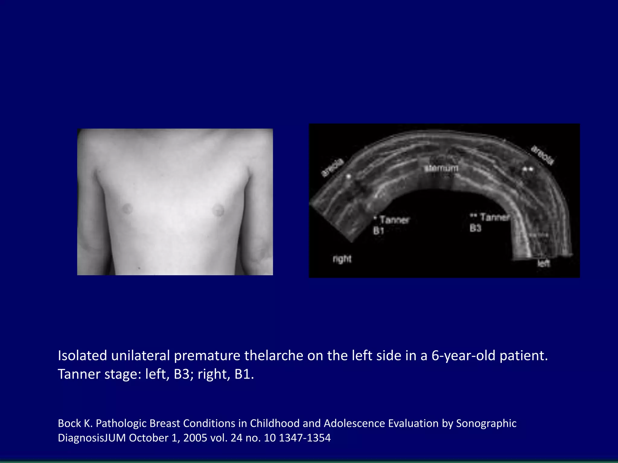 Ultrasound of pediatric and adolescent breast | PPTX