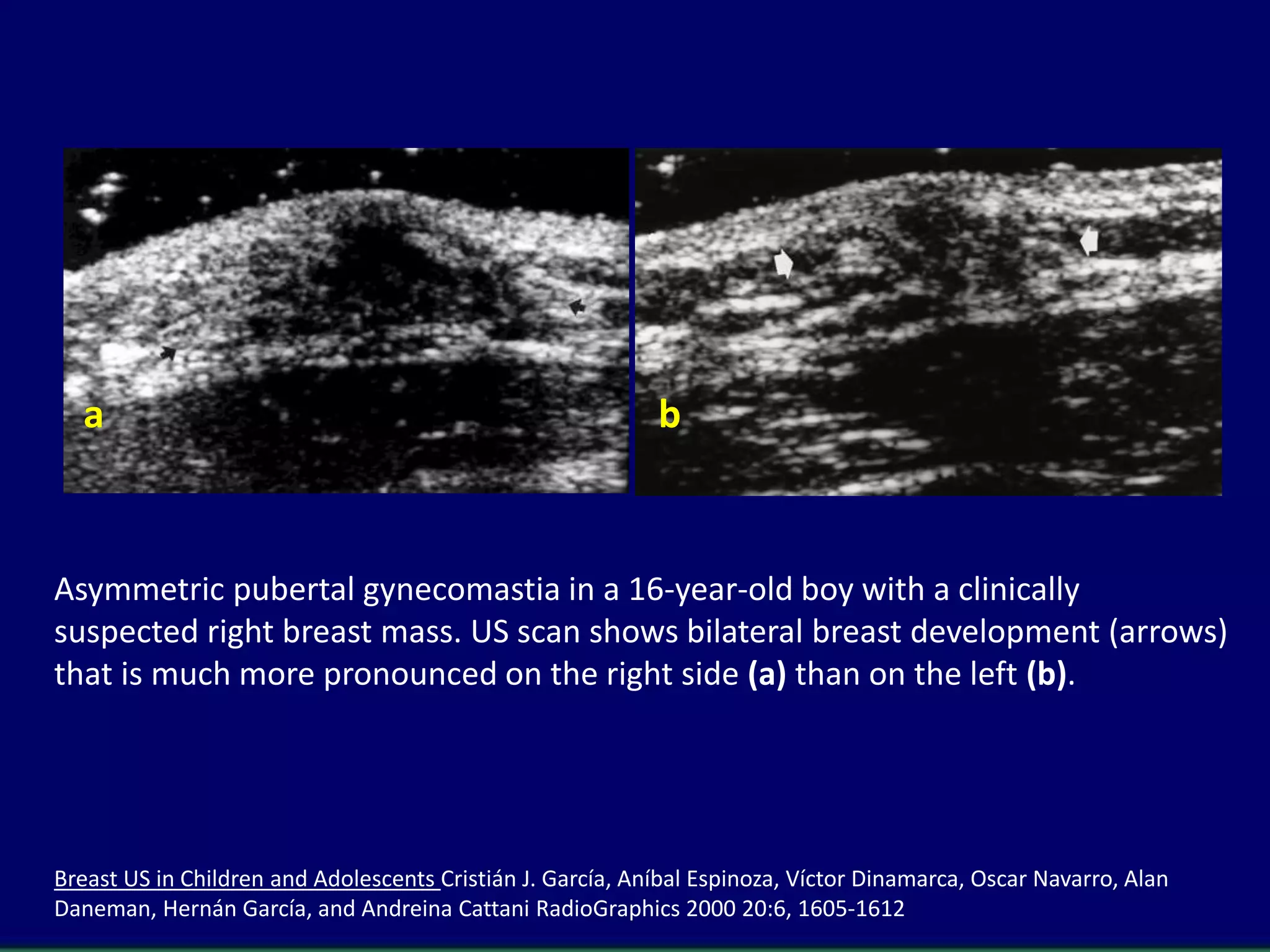 Ultrasound of pediatric and adolescent breast | PPTX