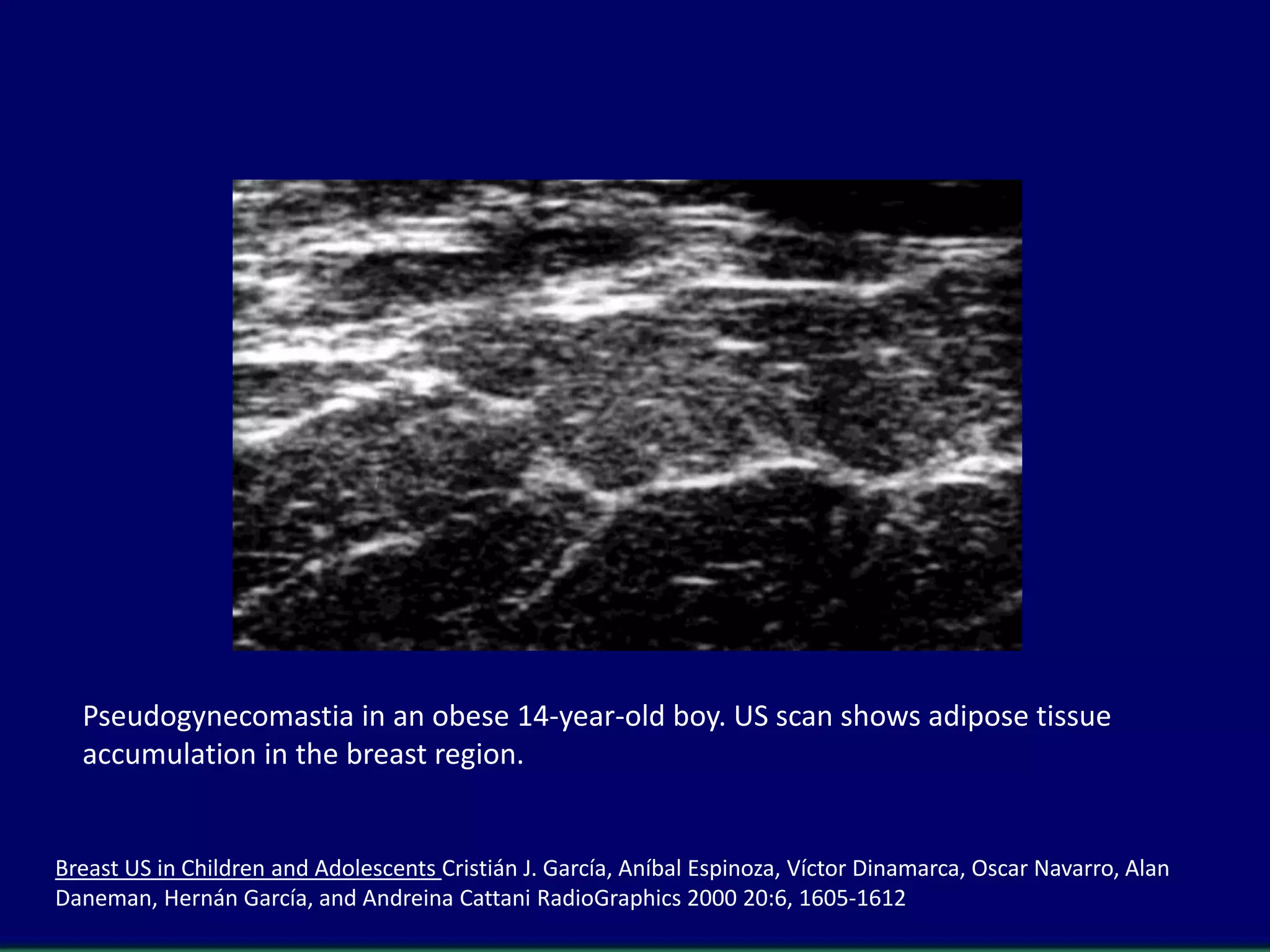 Ultrasound of pediatric and adolescent breast | PPTX